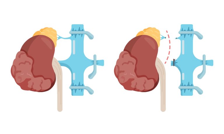 Conheça os tipos de nefrectomia - Urologista Aparecida, Urologista ...